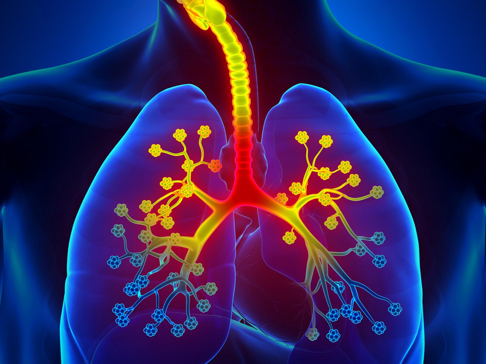 Chronische Bronchitis: Symptome und was hilft | Wunderweib